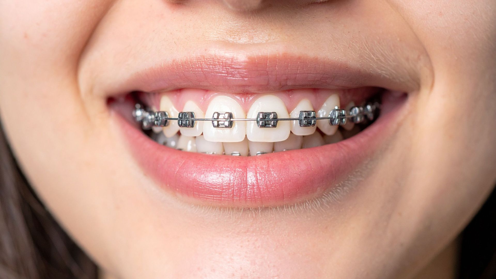 Are Damon Braces Better Than Traditional Options? | Comfort, Speed ...